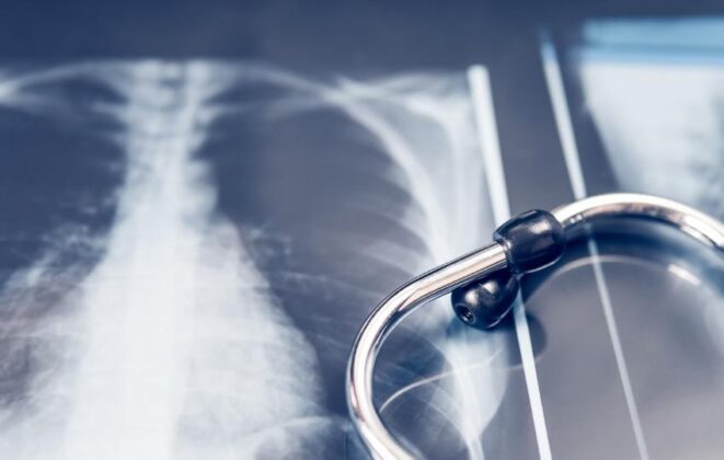 Critérios de Light diferenciam Derrame Pleural exsudativo de ...
