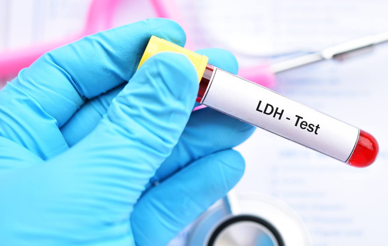 Lactato desidrogenase (LDH): quando solicitar e como interpretar seus ...